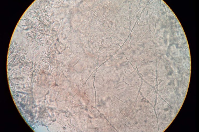 Fungal Infections (Mycosis): Types, causes and Treatments » Clinical ...